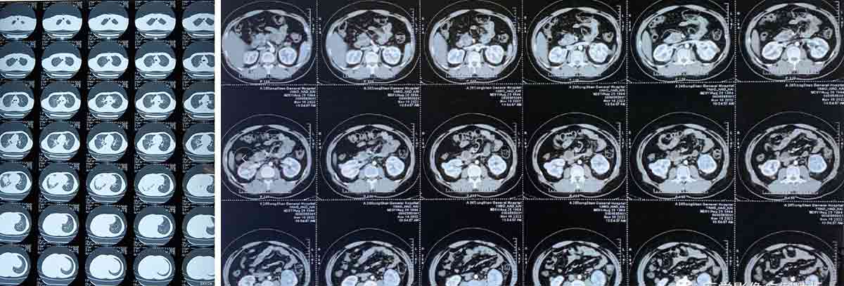Exploring Technical Aspects of Electron Beam Tomography vs. CT Scan ...